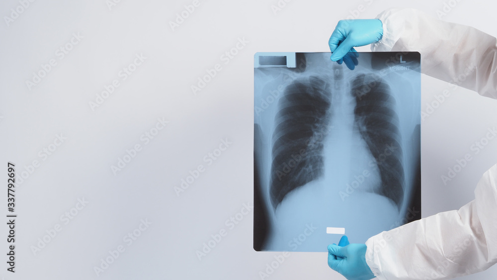Lungs x-ray film in doctor hands wearing medical gloves and PPE suit ...