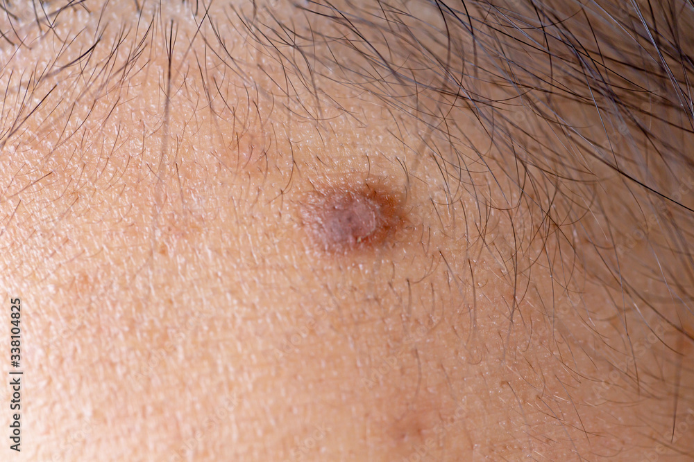 Woman 's problematic skin , acne scars ,oily skin and pore, dark spots ...