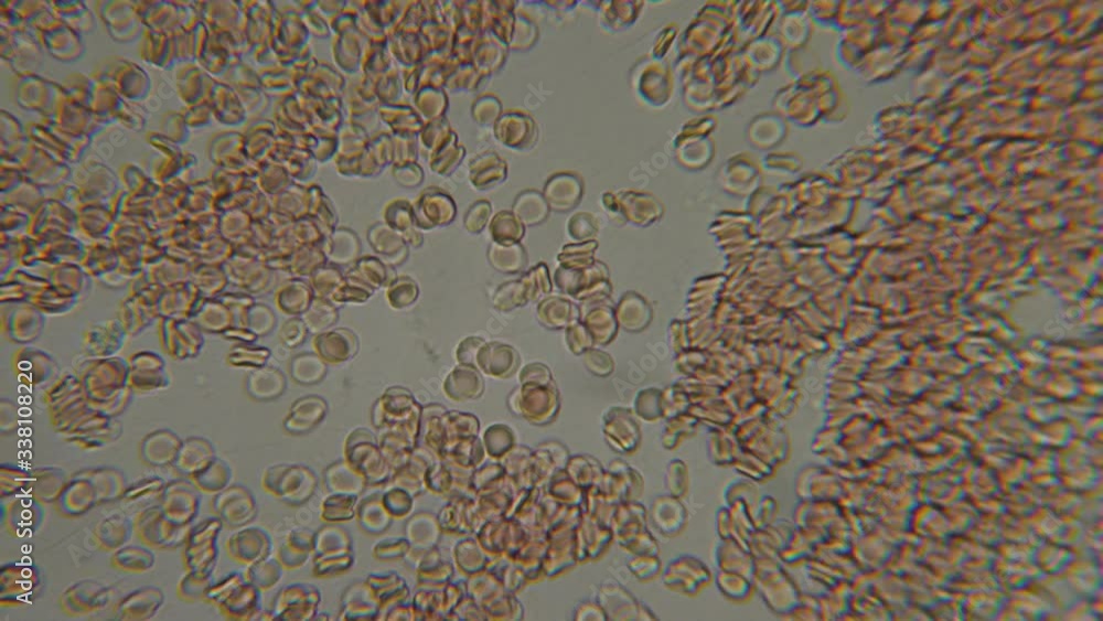 Human Blood, Diseases, Interstitial Fluid, Bacterial Background ...