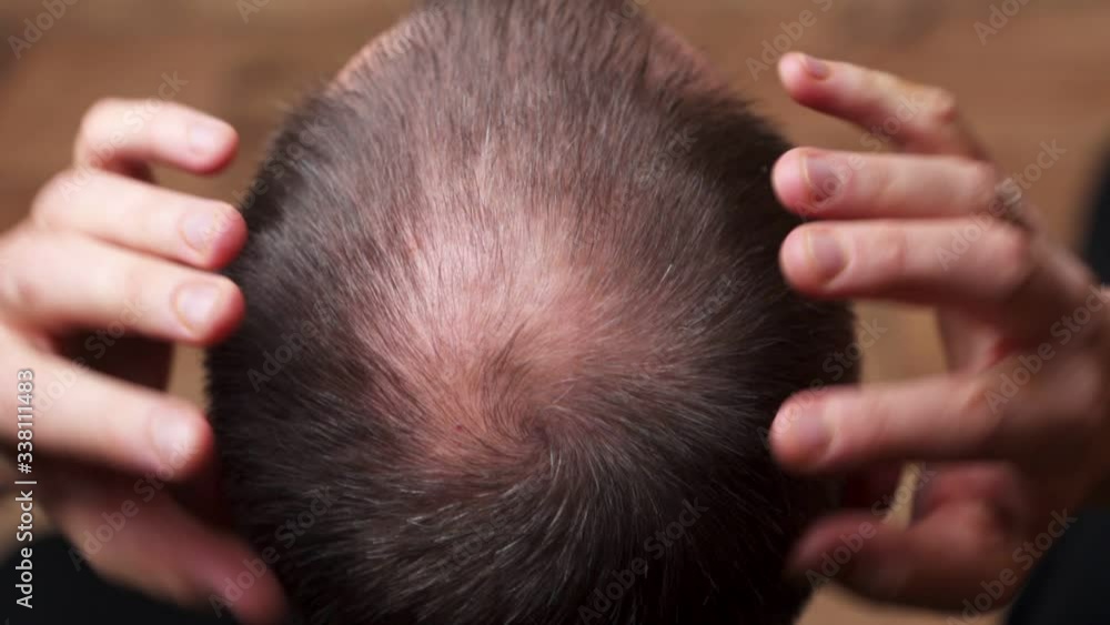 Man with hair loss problems close-up. Top of the head in focus while ...
