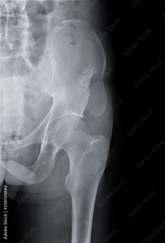 x-ray of a fracture of Ilium with displacement Stock Photo | Adobe Stock