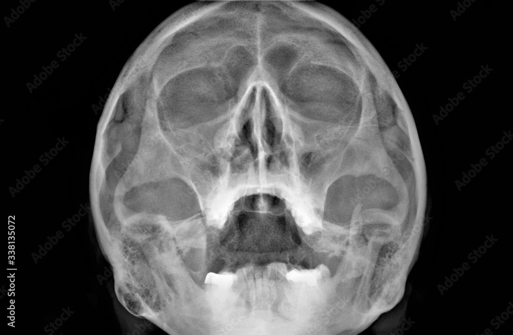 x-ray of the paranasal sinuses of the facial skull Stock Photo | Adobe ...
