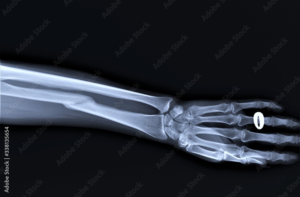 Foto de x-ray of the forearm bones with an incorrectly fused radius ...