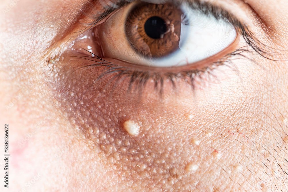 skin under man eye Stock Photo | Adobe Stock