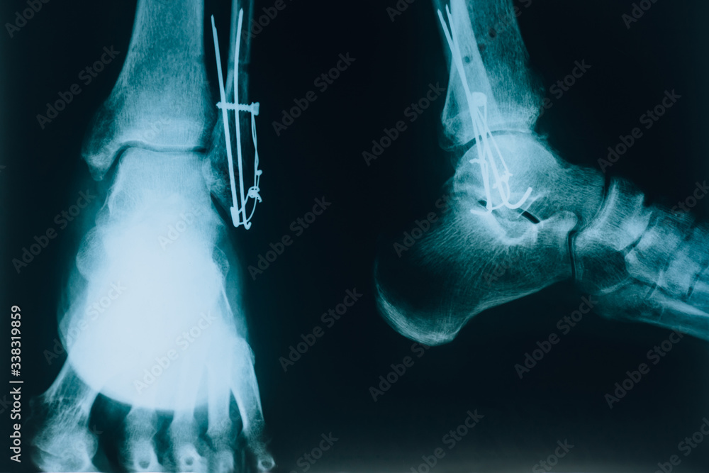 X-ray of the foot. A real x-ray picture of a sore foot. At the doctor’s ...