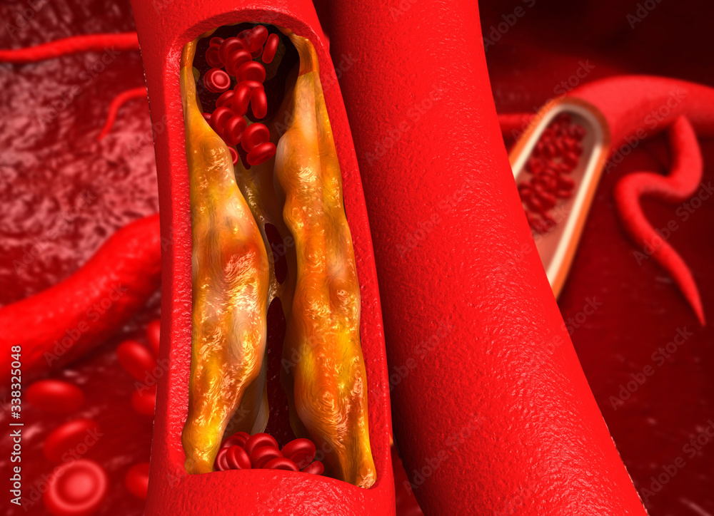 Clogged arteries,Blocked blood vessel, artery with bad cholesterol. 3d ...