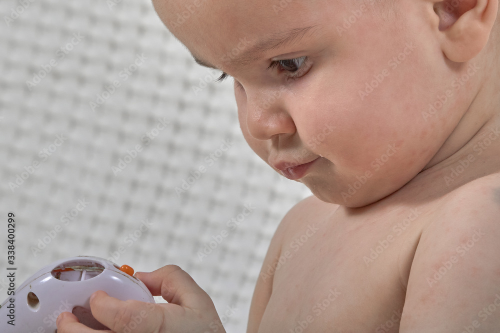 roseola rash a viral rash on the skin of a child Stock Photo | Adobe Stock