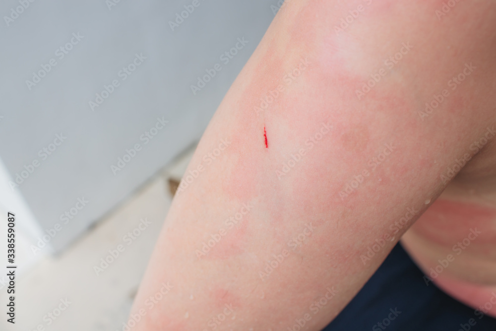 Dermatitis Herpetiformis skin rash in a woman with Nonceliac Gluten ...