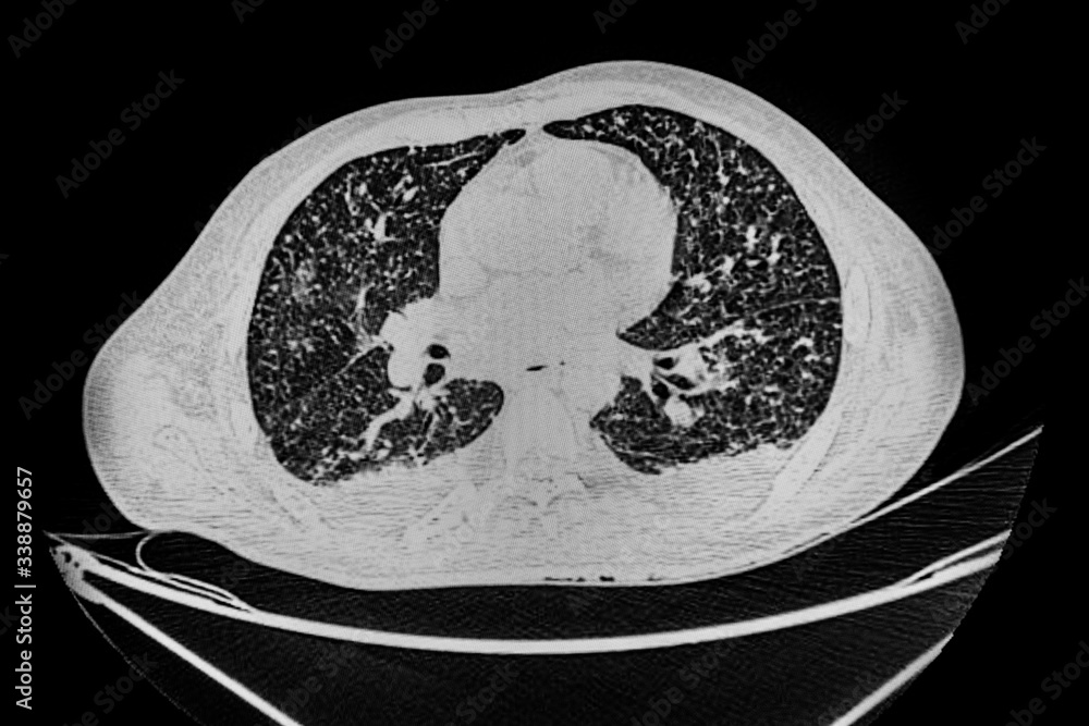 Chest x-ray with lower respiratory infection Stock Photo | Adobe Stock