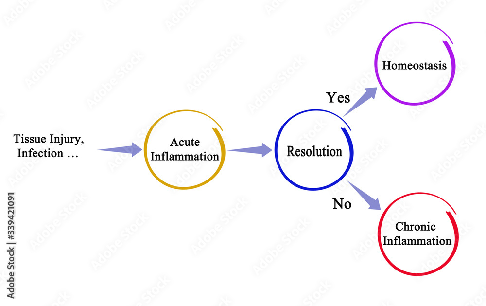 Two ways of resolution of acute inflamation Stock Illustration | Adobe ...