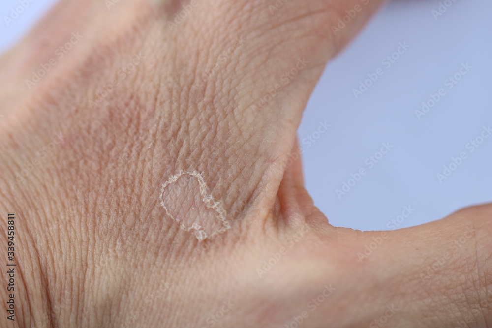 Peeling reddened skin on the back of hand near the thumb after the heat ...