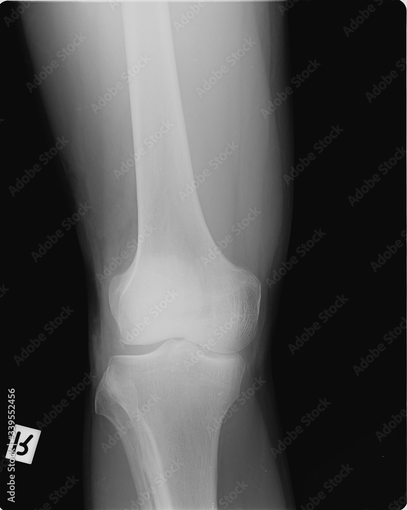 X-ray scan of a right human leg including knee joint Stock Photo ...