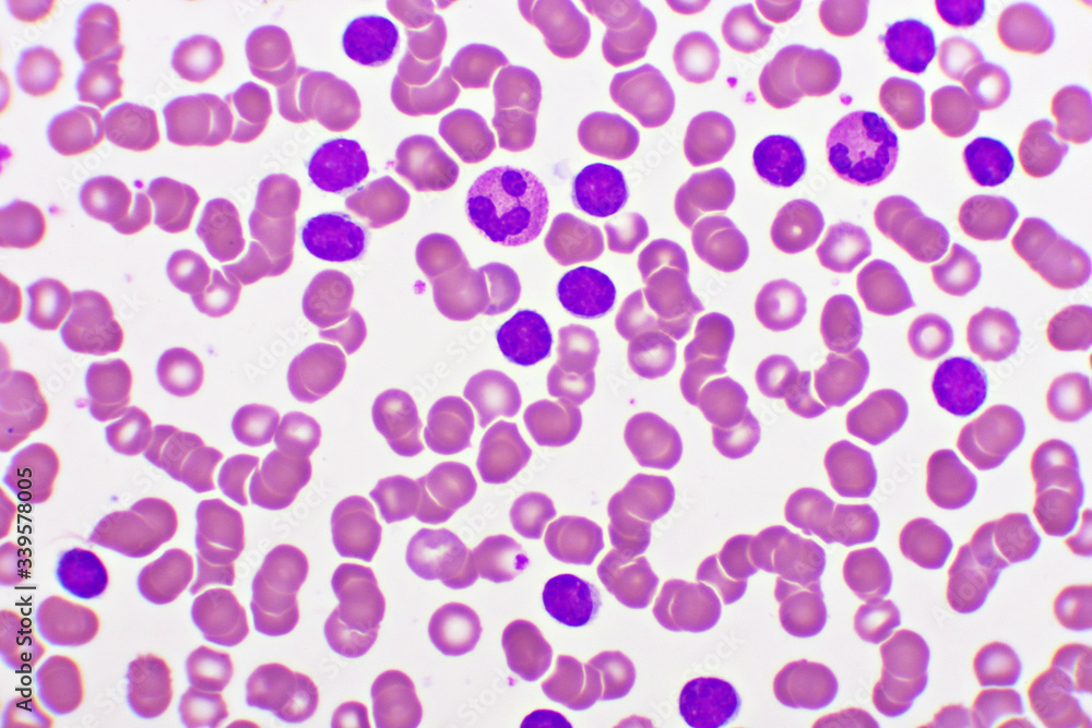 Foto de Picture of acute lymphocytic leukemia or ALL cells in blood ...
