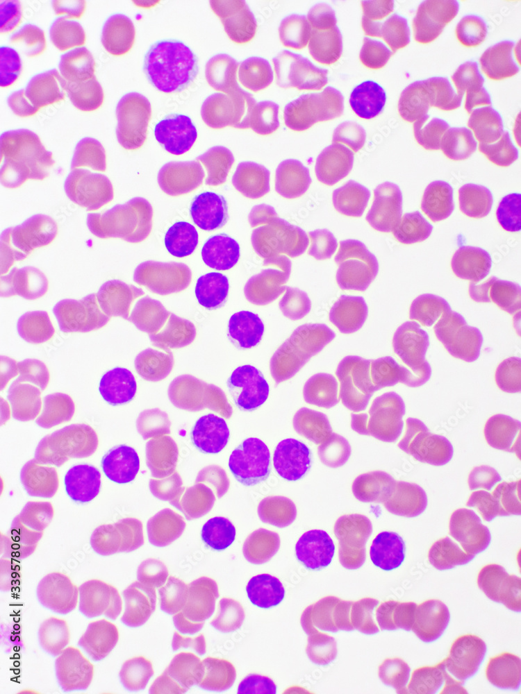 Picture of acute lymphocytic leukemia or ALL cells in blood smear ...