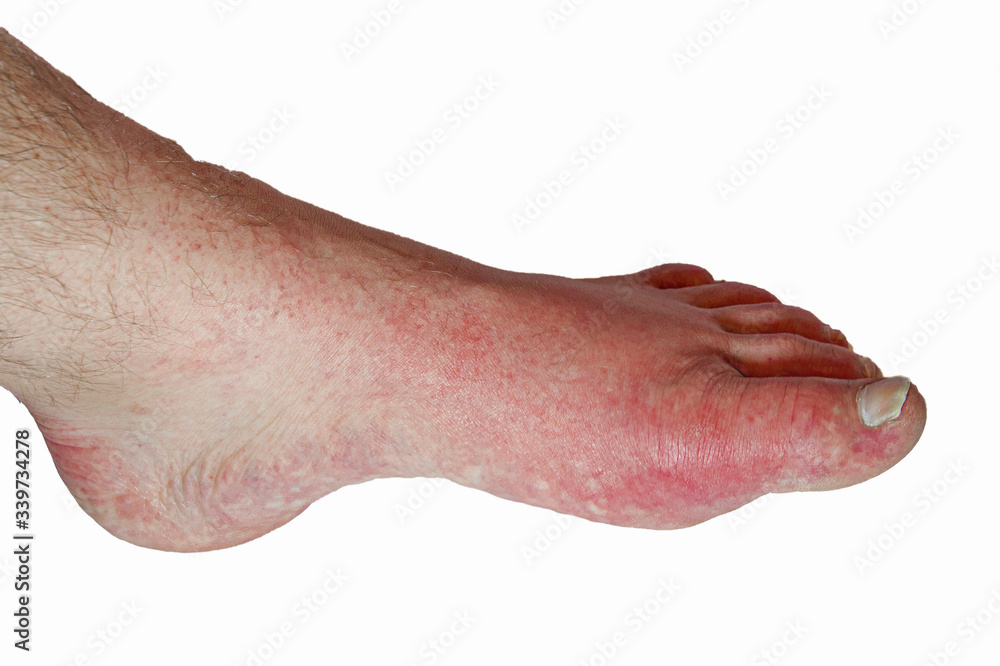 Foot of Gout swollen isolated on white Stock Photo | Adobe Stock