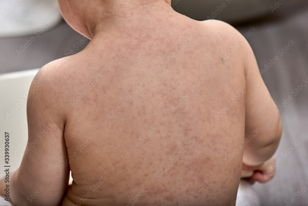 roseola rash a viral rash on the skin of a child Stock Photo | Adobe Stock