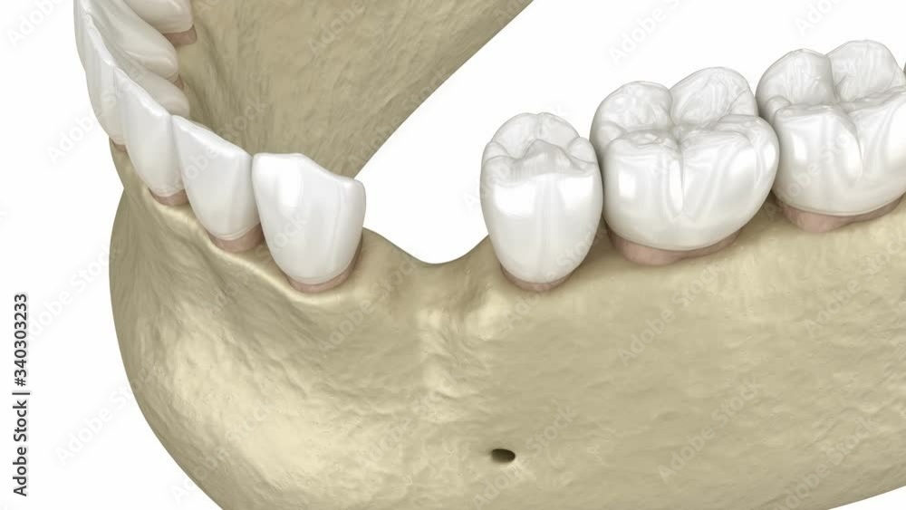 Augmentation Surgery - Adding new bone and implant. 3D animation vídeo ...