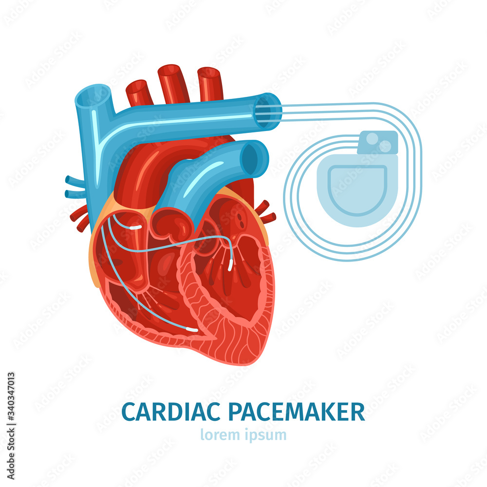 Heart Pacemaker Illustration Stock Vector | Adobe Stock
