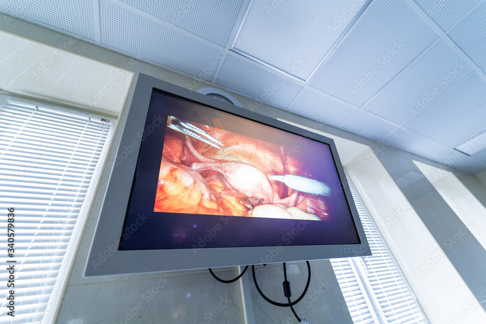 Process of surgery operation using laparoscopic equipment. Operating ...