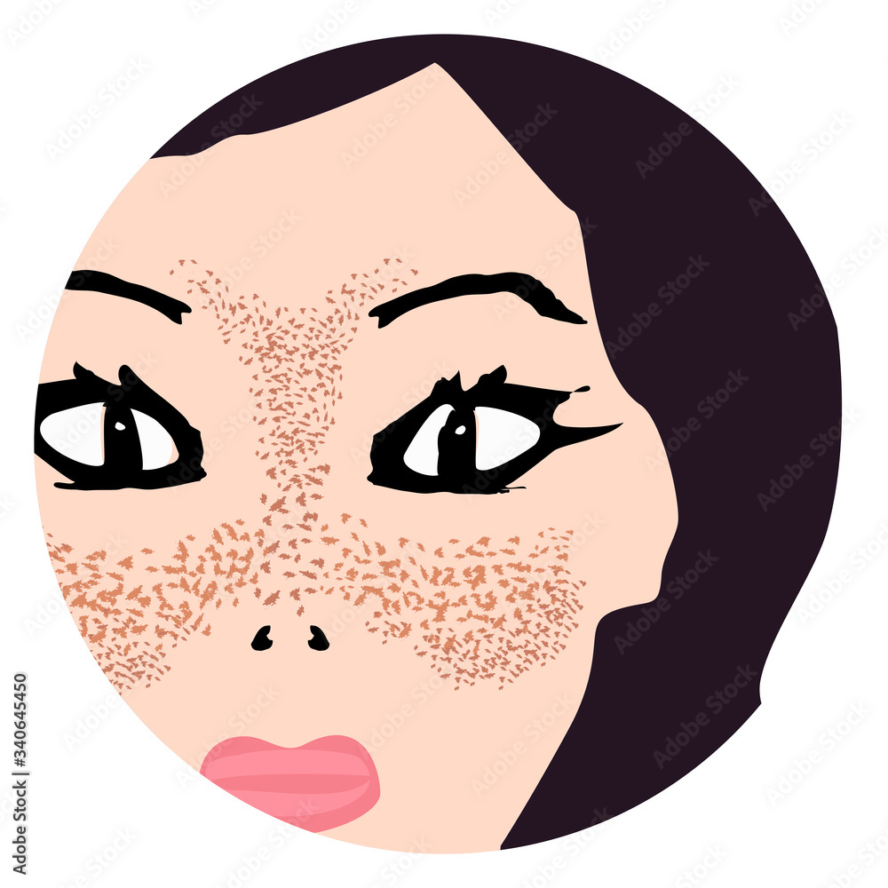 Freckles on the face. Pigmentation on the skin. A pigmented spot on the ...