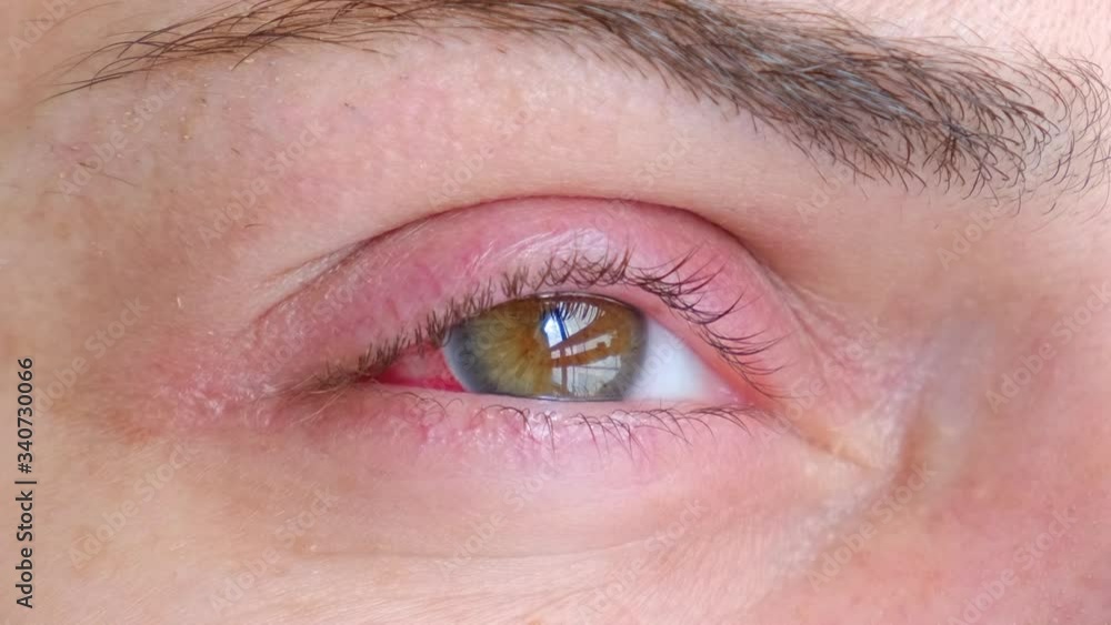 Woman eye with broken blood vessels, blinking - close up. Blood in eye ...