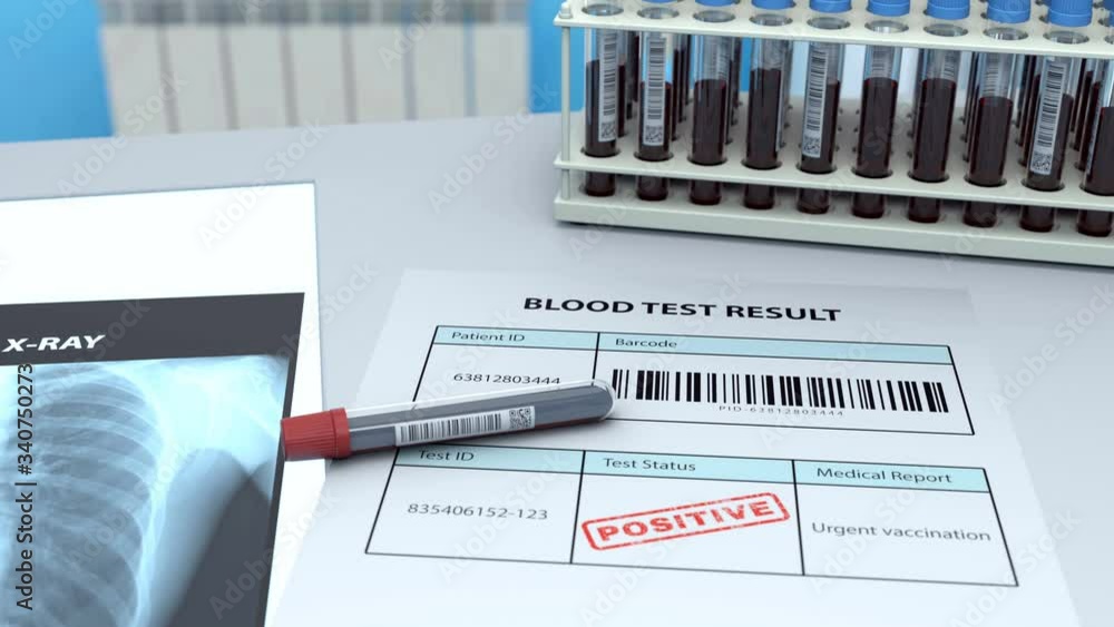 3D scene in the lab with a lung x-ray and a test tube with a blood test ...