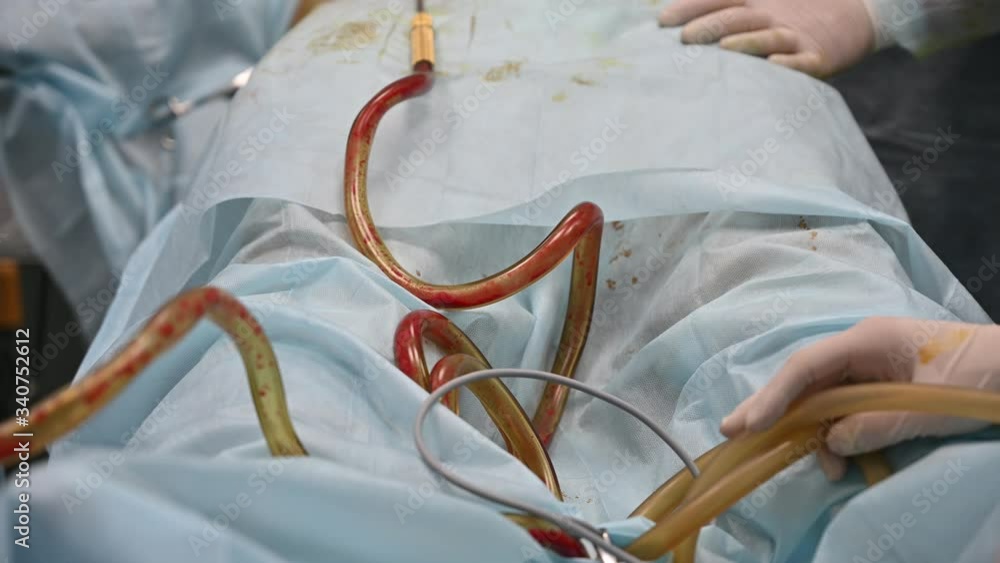 Bloody pipes during liposuction surgery operation on unrecognizable ...