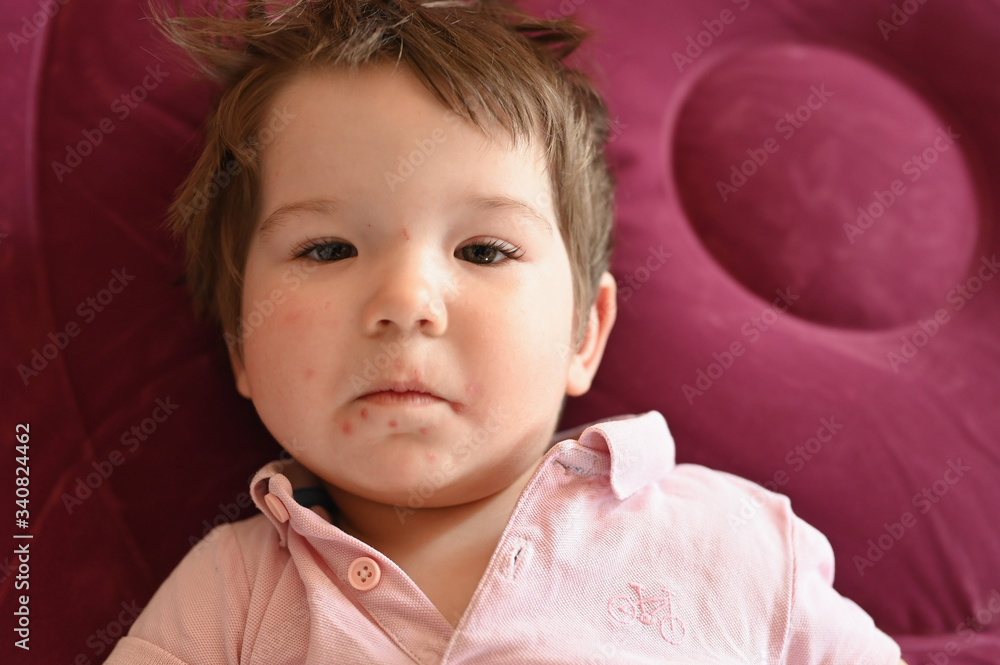 portrait of a child with a rash on his face. herpes in a child. the ...