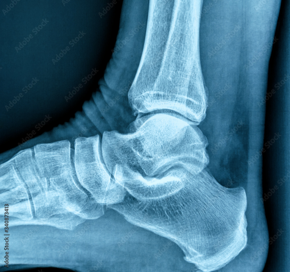 X-ray of human heel spur Stock Photo | Adobe Stock