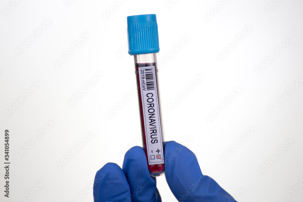 Blood sample of coronavirus test made in the world pandemic in 2020 ...
