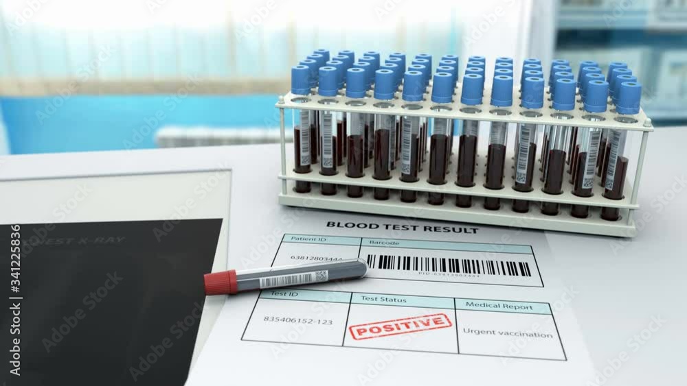 X-ray of the lungs after a making blood test to make an accurate ...