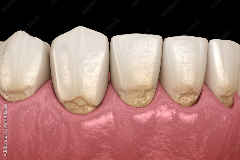 Abfraction of anterior teeth. Medically accurate 3D illustration Stock ...