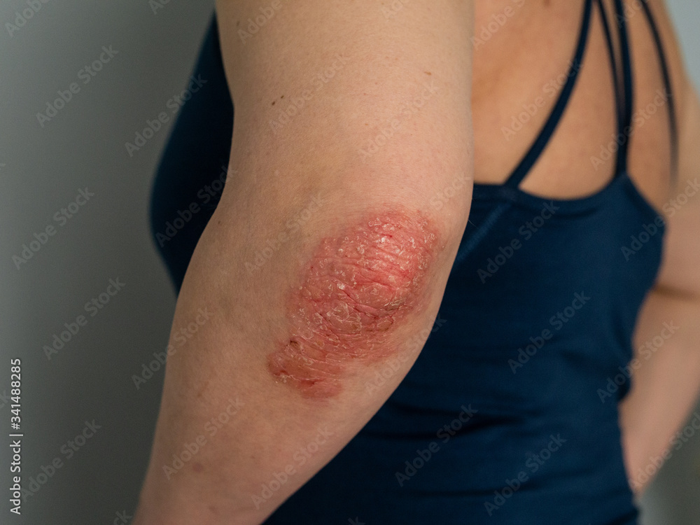 Psoriasis on elbow. Isolated. Closeup of rash and scaling on the ...