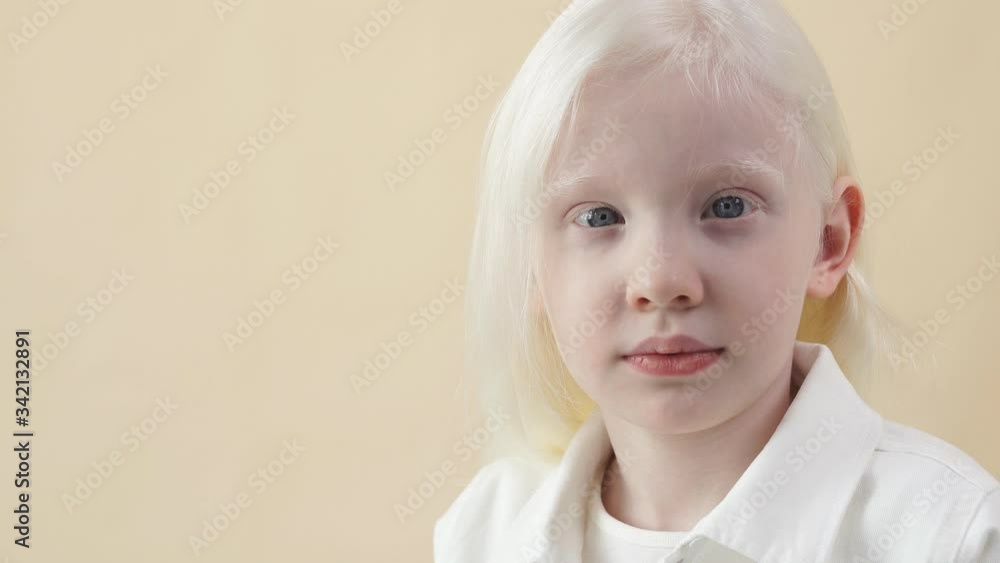 Close-up portrait of little caucasian girl with albinism syndrome ...