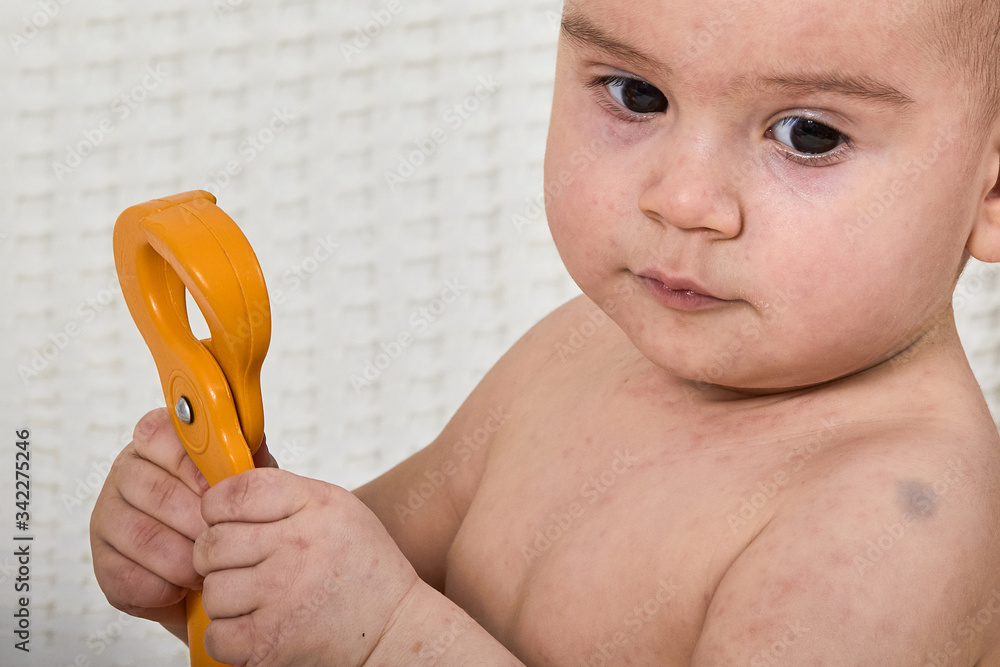 roseola rash a viral rash on the skin of a child Stock Photo | Adobe Stock