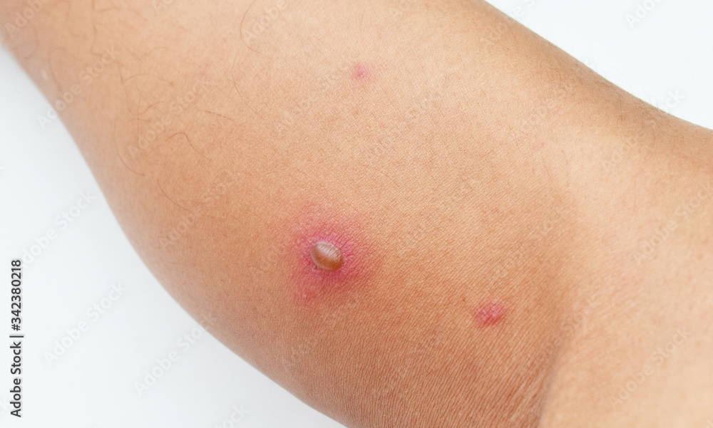 Injured skin - burning skin, blistered skin, wounded skin from insect ...