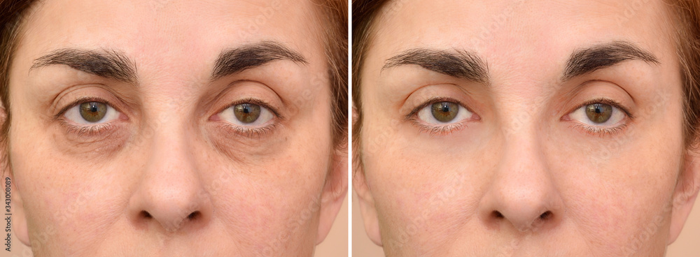 Female eye bags before and after cosmetic treatment or plastic ...