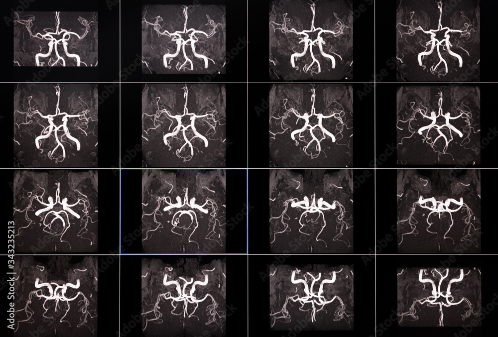 MRT images of the human head vessels Stock Photo | Adobe Stock
