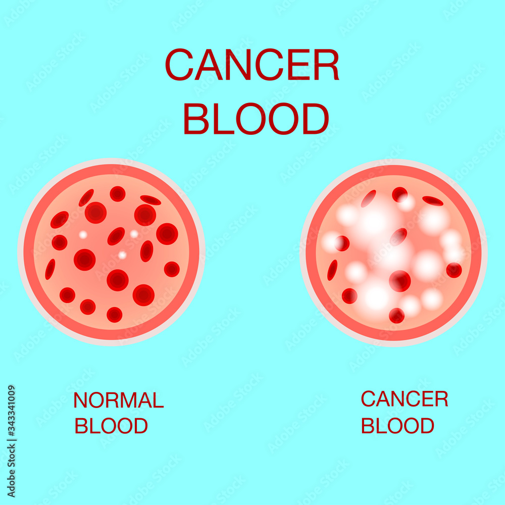 Infographic image of leukemia. Leukaemia disease awareness.Leukemia ...