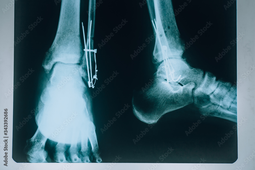 X-ray two feet in projection, heel, bones and joints of the legs Stock ...