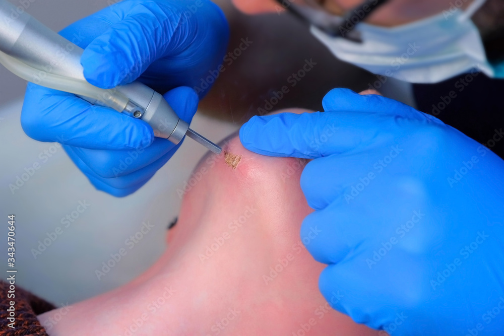 Surgeon removing scar on woman's chin using laser, burning skin, beauty ...