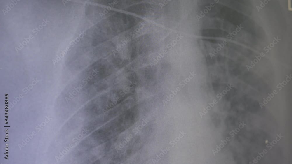 Video „Doctor checking x-ray of lungs. Remote check-up. pulmonologist ...