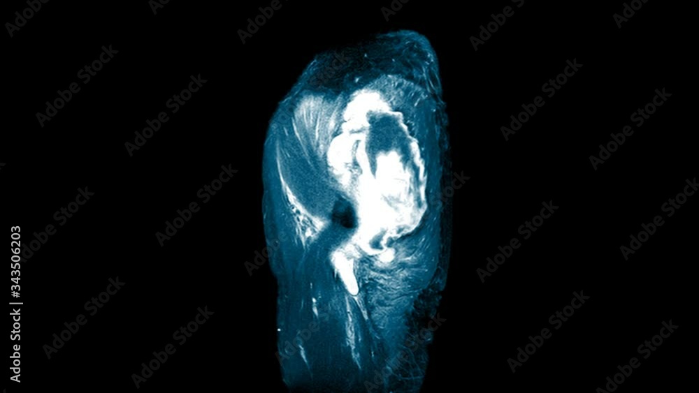 Magnetic Resonance Imaging (MRI) of both hip sagittal plane. Finding A ...