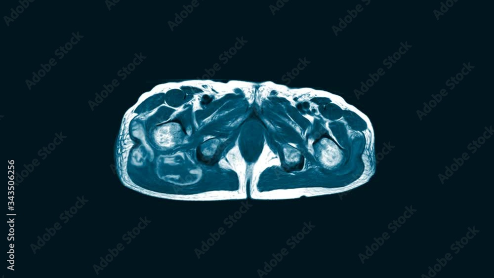 Magnetic Resonance Imaging (MRI) of both hip sagittal plane. Finding A ...