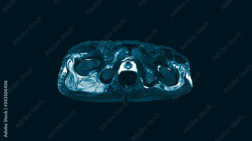 Magnetic Resonance Imaging (MRI) of both hip sagittal plane. Finding A ...
