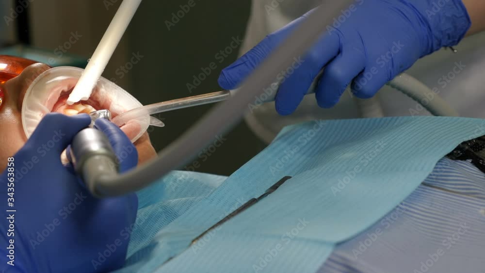 Dental clinic concept, Setting of veneers in modern dentistry. Close-up ...