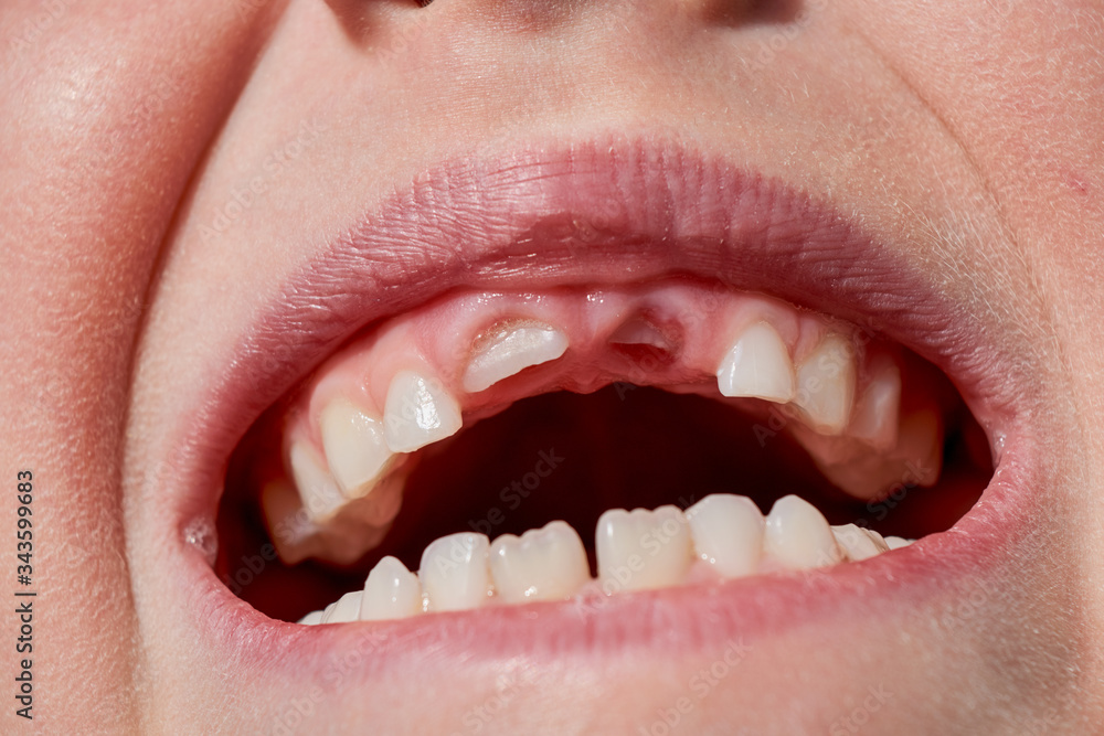 Stockfoto med beskrivningen Children's milk teeth. The mouth is open ...