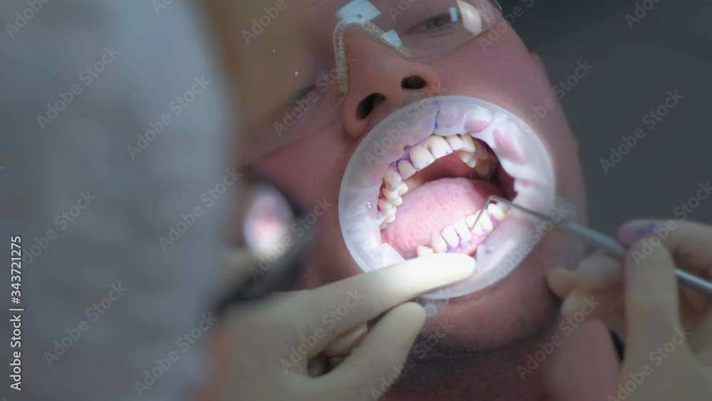 Dentist showing defects on patient's teeth using blue gel and needle in ...