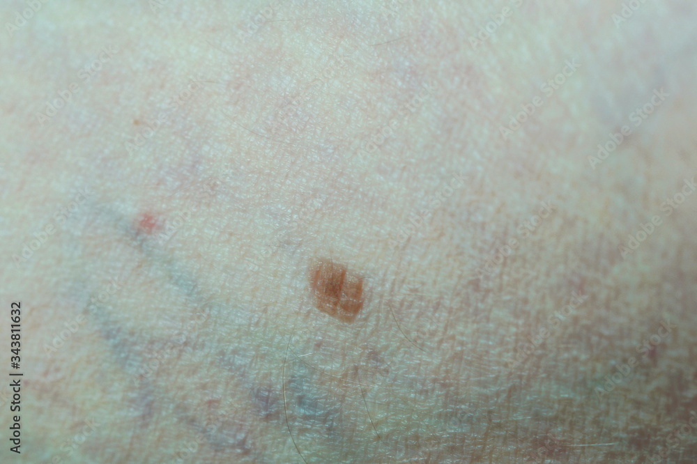 Basal cell carcinoma, benign skin cancer, basal-cell cancer on human ...