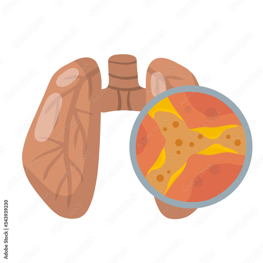Lung disease. Blockage of canal. Mucus in alveoli. Breathing problems ...